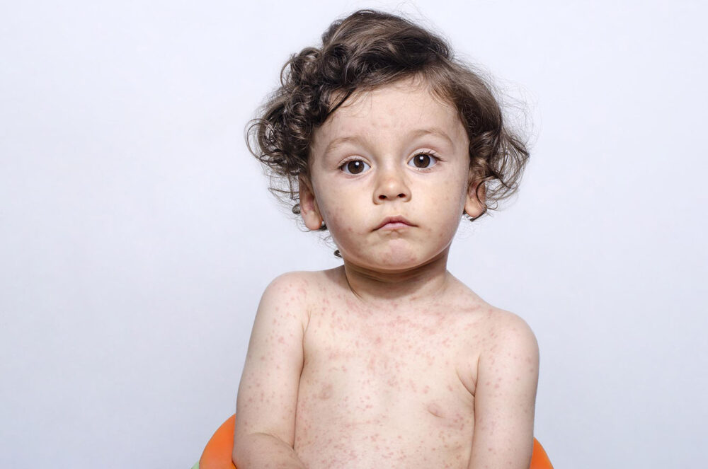 elimination-of-measles-and-rubella-in-europe-clinical-virology-network